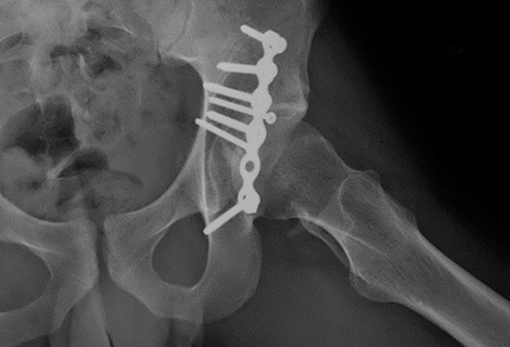 PRÓTESIS DE CADERA - Instituto de Traumatología Estévez