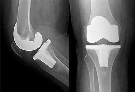 PRÓTESIS DE RODILLA - Instituto de Traumatología Estévez